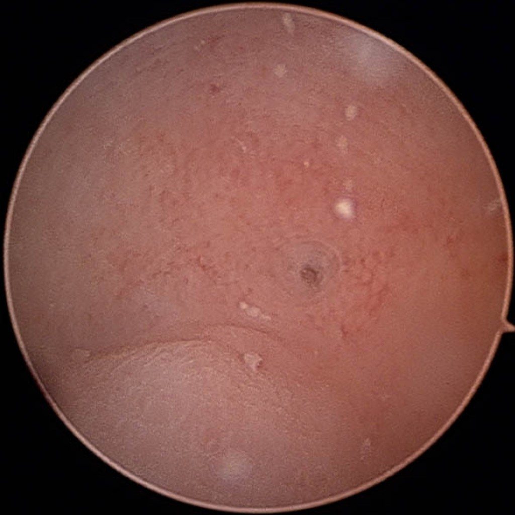 Advanced Hysteroscopic Surgery | Brisbane Obstetrician & Gynaecologist ...