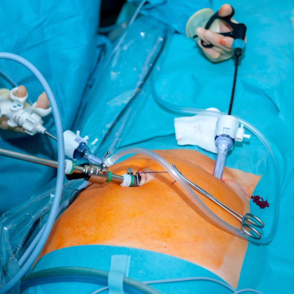 Laparoscopic Hysterectomy Brisbane Obstetrician And Gynaecologist Dr