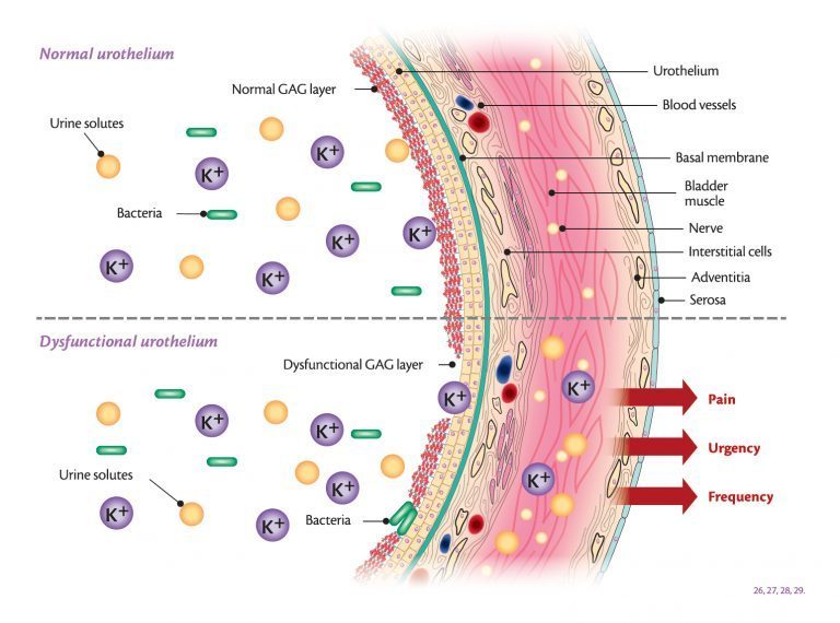 Painful Bladder Syndrome – Interstitial Cystitis (PBS/IC) | Brisbane ...
